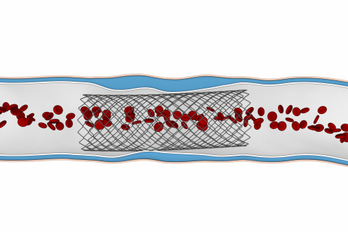 Abbott lands FDA Approval for heart stent | health enews
