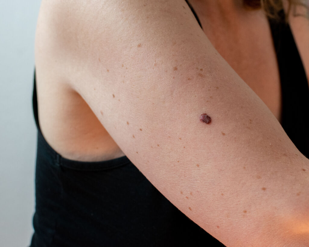 Protect Yourself From These 3 Common Skin Cancers Health Enews